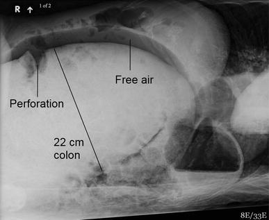 Abdominal a-lines: a simpler sonographic sign of pneumoperitoneum ...