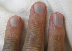 Minocycline Toxicity: Case Files of the University of Massachusetts ...