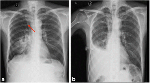 The Azygous Lobe of the Lung: in the Case of Lung Cancer | SpringerLink