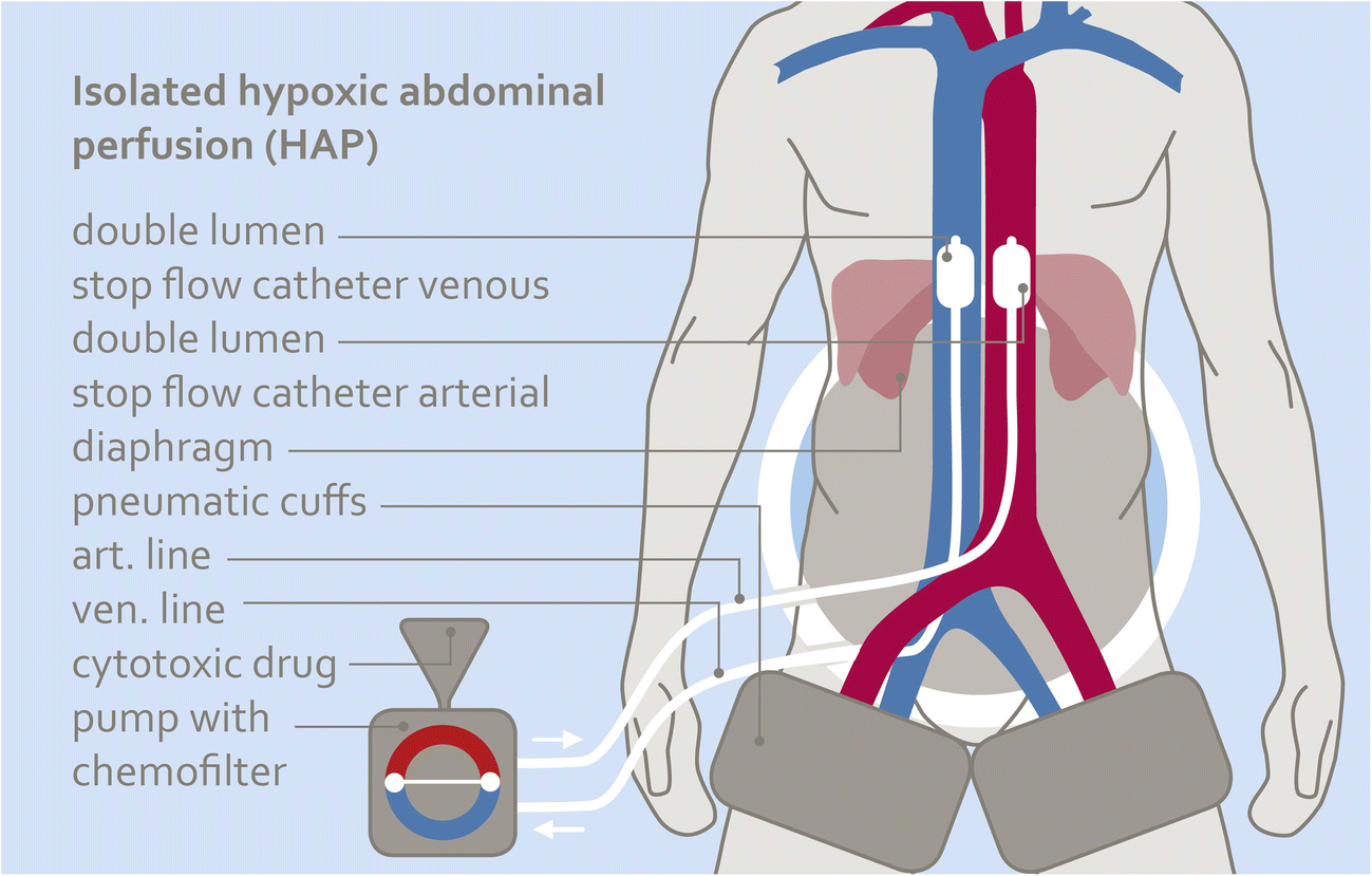 Hypoxic Isolated Abdominal Perfusion (HAP) chemotherapy for non ...