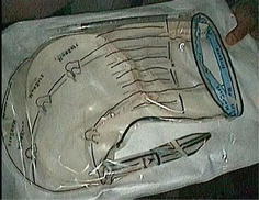 Laparoscopic Morcellation of Fibroid and Uterus In-Bag | SpringerLink