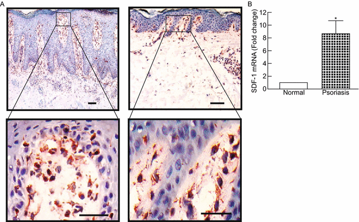 Dermal fibroblast expression of stromal cell-derived factor-1 (SDF-1 ...