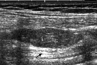 Ultrasound features of deep-seated lipomas | SpringerLink