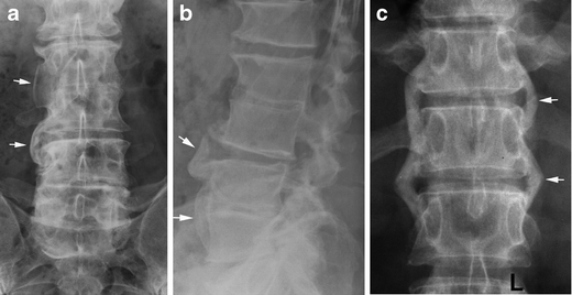 Imaging the spine in arthritis—a pictorial review | SpringerLink