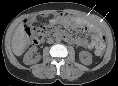 Omental cakes: unusual aetiologies and CT appearances | SpringerLink