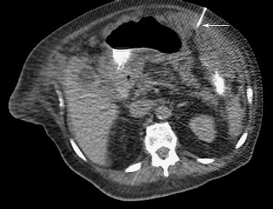 Omental cakes: unusual aetiologies and CT appearances | SpringerLink