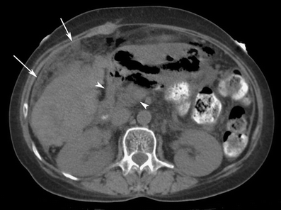 Omental cakes: unusual aetiologies and CT appearances | SpringerLink