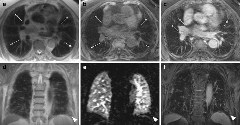 MRI of the lung (3/3)—current applications and future perspectives ...