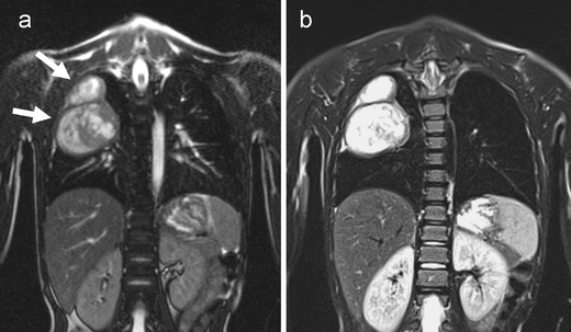 MRI of the lung (2/3). Why … when … how? | SpringerLink