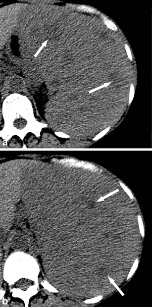 Computed tomography of the spleen: how to interpret the hypodense ...