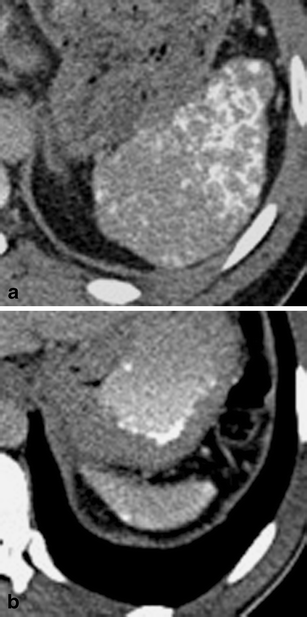 Computed tomography of the spleen: how to interpret the hypodense ...