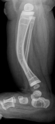 Radiographic features of osteogenesis imperfecta | SpringerLink