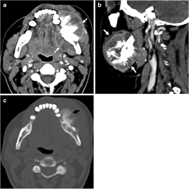 Anatomy and pathology of the masticator space | SpringerLink