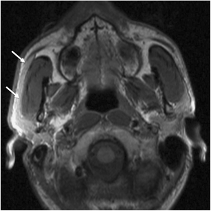 Anatomy and pathology of the masticator space | SpringerLink