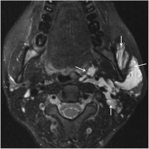 Anatomy and pathology of the masticator space | SpringerLink
