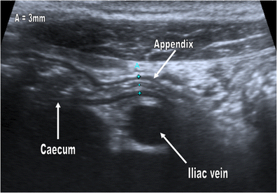Ultrasound assessment of acute appendicitis in paediatric patients ...
