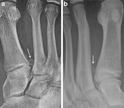 Sesamoids and accessory ossicles of the foot: anatomical variability ...