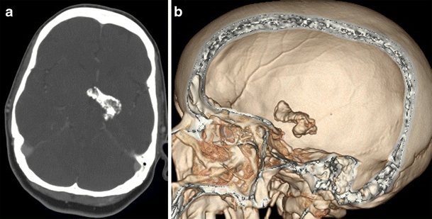 Brain stones revisited—between a rock and a hard place | SpringerLink