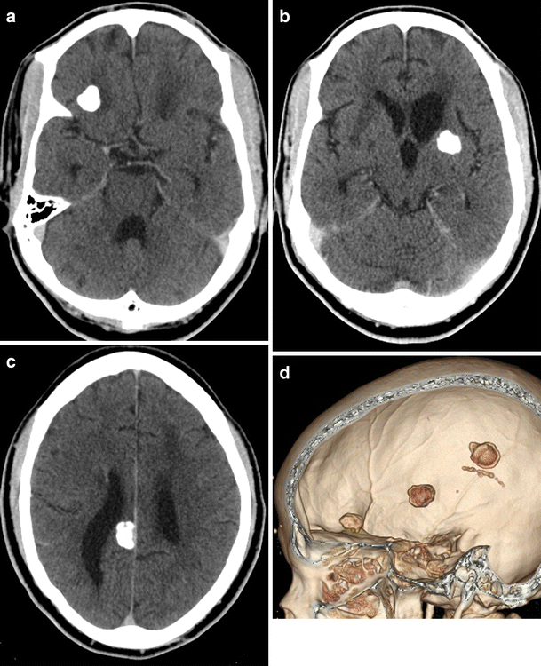 Brain stones revisited—between a rock and a hard place | SpringerLink