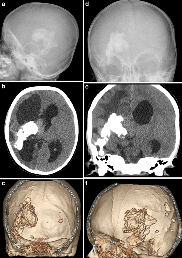 Brain stones revisited—between a rock and a hard place | SpringerLink
