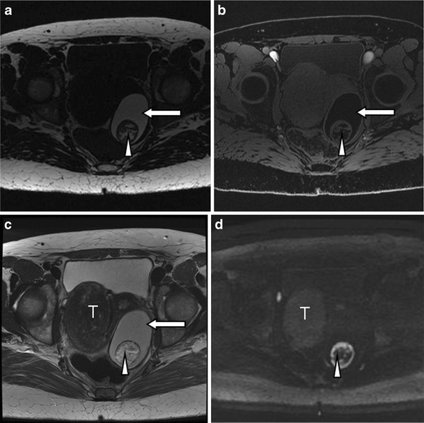 Struma ovarii: role of imaging? | SpringerLink