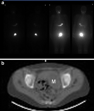 Struma ovarii: role of imaging? | SpringerLink