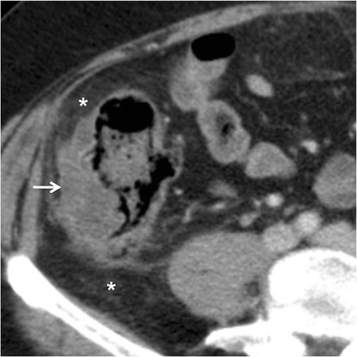 Bowel wall thickening at CT: simplifying the diagnosis | SpringerLink