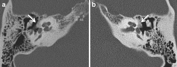 Imaging in otosclerosis: A pictorial review | SpringerLink