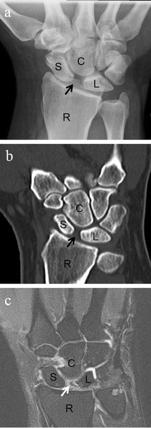 Scapholunate advanced collapse: a pictorial review | SpringerLink