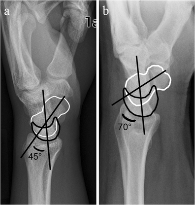 Scapholunate advanced collapse: a pictorial review | SpringerLink