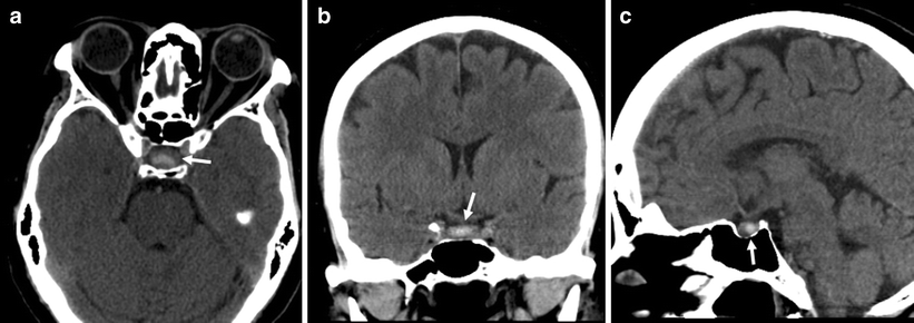 Pituitary apoplexy: an update on clinical and imaging features ...