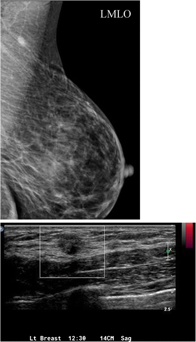 A practical approach to imaging the axilla | SpringerLink