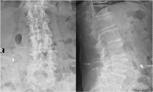 Baastrup’s disease (kissing spines syndrome): a pictorial review ...