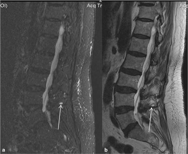 Baastrup’s disease (kissing spines syndrome): a pictorial review ...