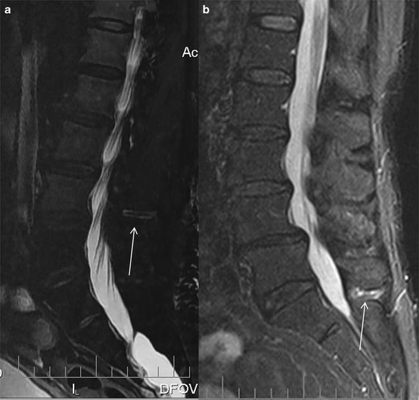 Baastrup’s disease (kissing spines syndrome): a pictorial review ...