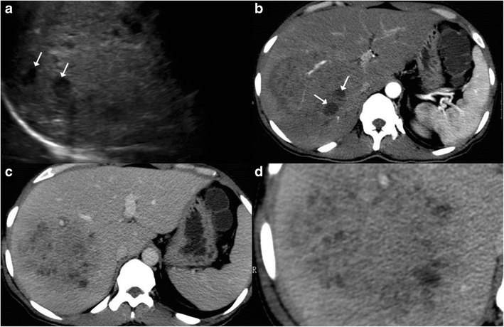 Hepatic tuberculosis: a multimodality imaging review | SpringerLink