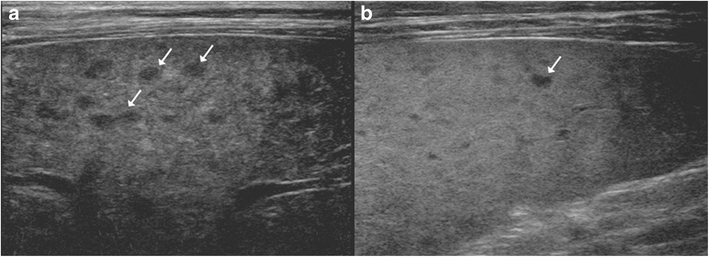 Hepatic tuberculosis: a multimodality imaging review | SpringerLink