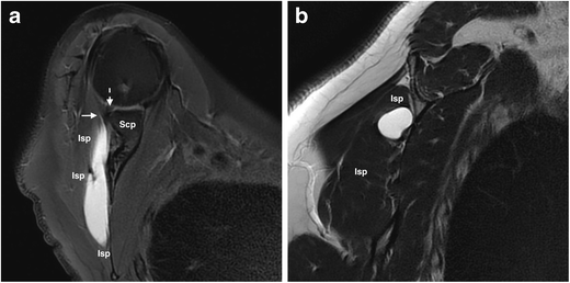 Spectrum of MRI features of ganglion and synovial cysts | SpringerLink
