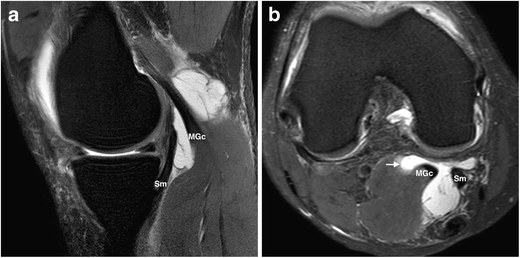 Spectrum of MRI features of ganglion and synovial cysts | SpringerLink