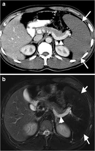 Imaging findings of splenic emergencies: a pictorial review | SpringerLink
