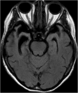 Bilateral temporal lobe disease: looking beyond herpes encephalitis ...