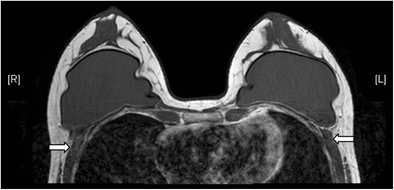 Magnetic resonance imaging of breast augmentation: a pictorial review ...