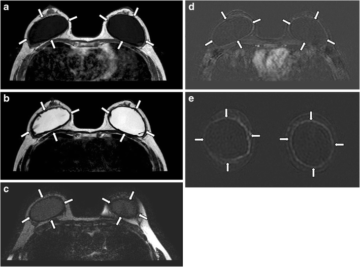 Magnetic resonance imaging of breast augmentation: a pictorial review ...