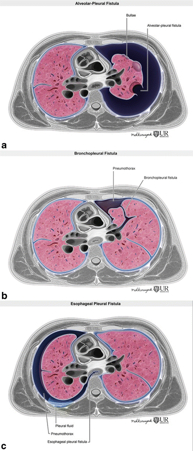 Demystifying the persistent pneumothorax: role of imaging | SpringerLink