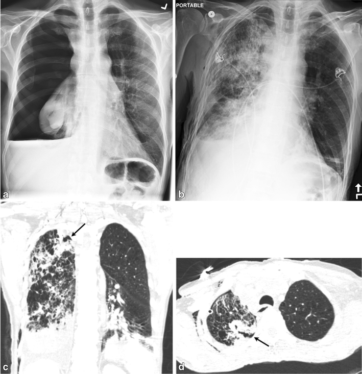 Demystifying the persistent pneumothorax: role of imaging | SpringerLink