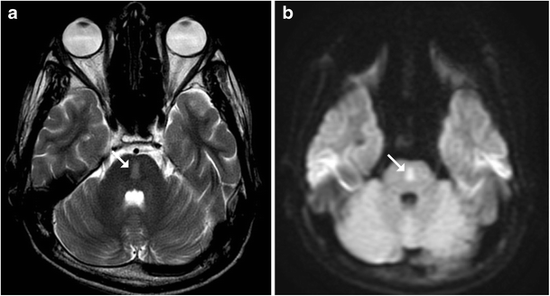 Paediatric brainstem: A comprehensive review of pathologies on MR ...