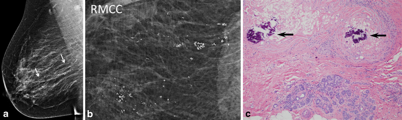 Idiopathic granulomatous mastitis: imaging update and review | SpringerLink
