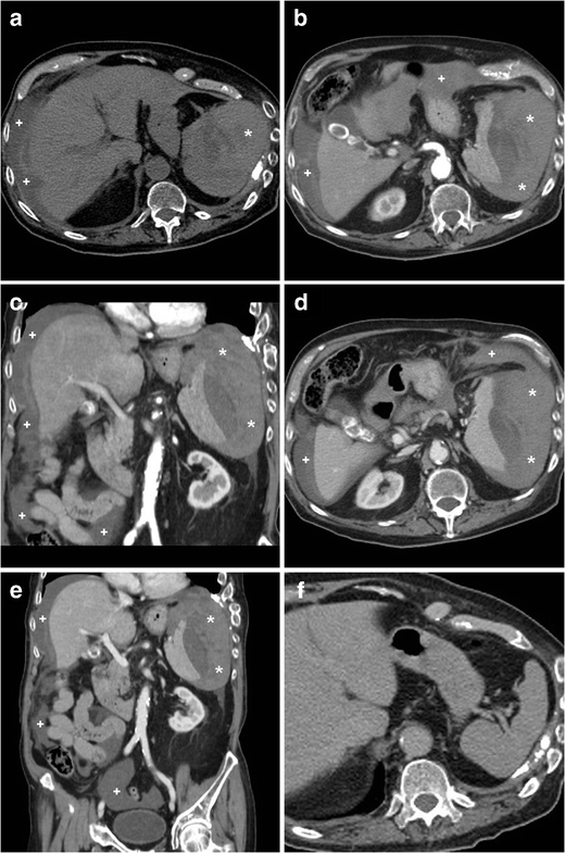 Atraumatic splenic rupture, an underrated cause of acute abdomen ...