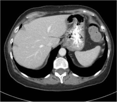 Causes of hepatic capsular retraction: a pictorial essay | SpringerLink