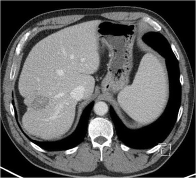 Causes of hepatic capsular retraction: a pictorial essay | SpringerLink